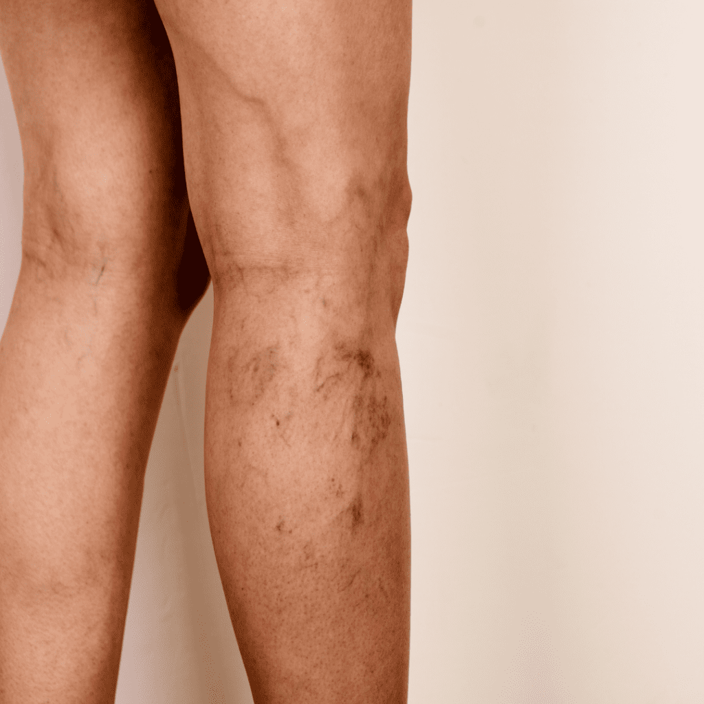 Télangectasies - Varicosités - Points de rubis | Cliniques Viva